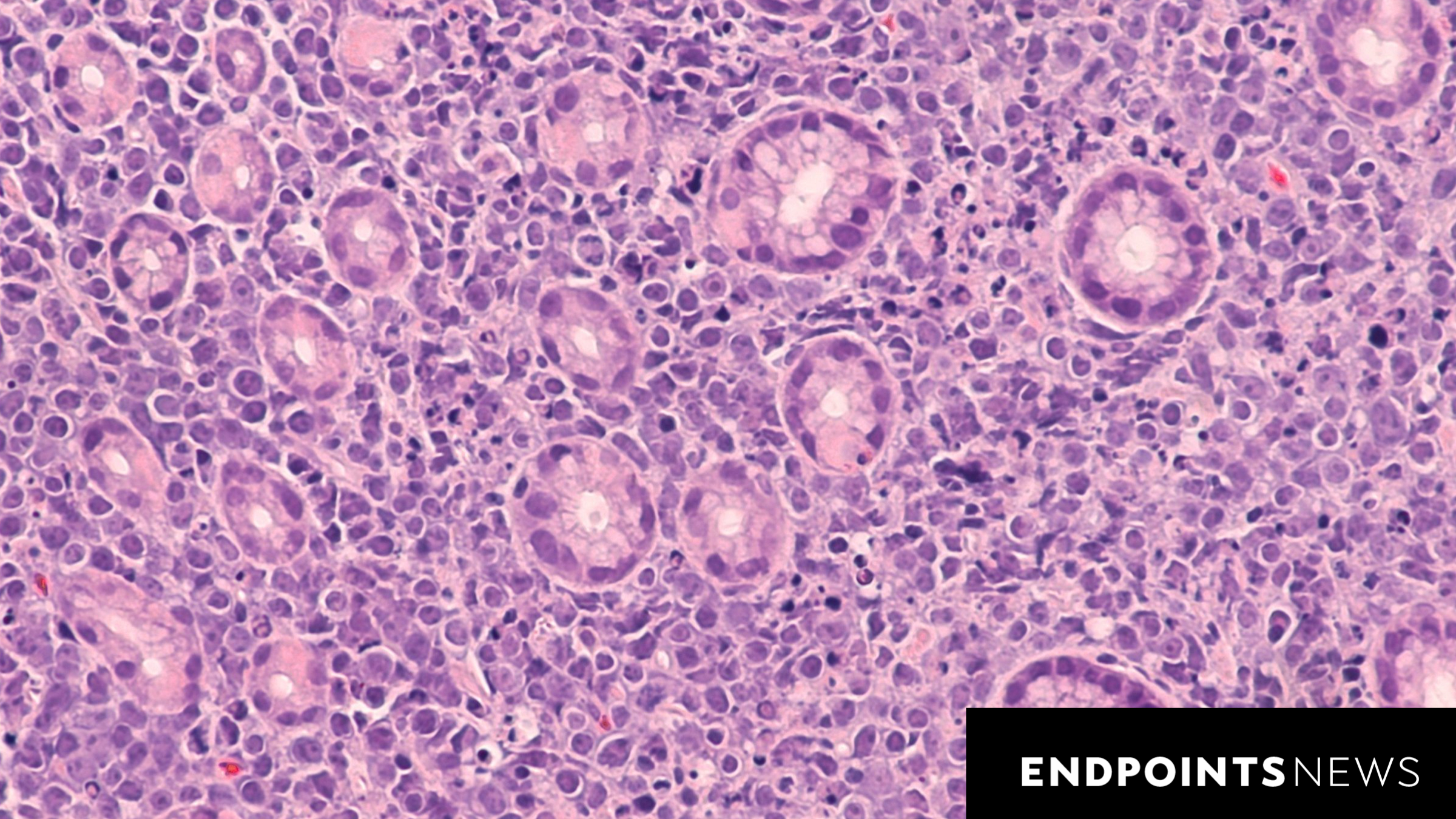 ImmunityBio cell therapy posts encouraging early data in rare blood cancer